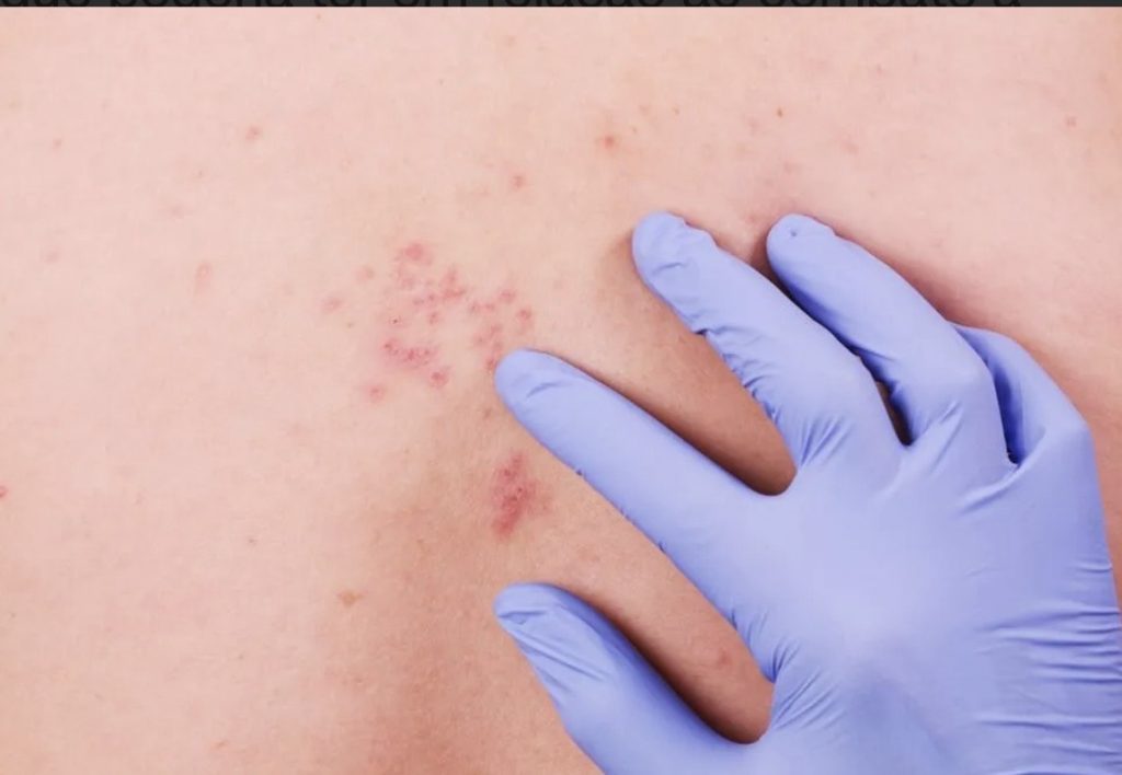 Ministério da Saúde decide não incorporar vacina do herpes zóster ao ...